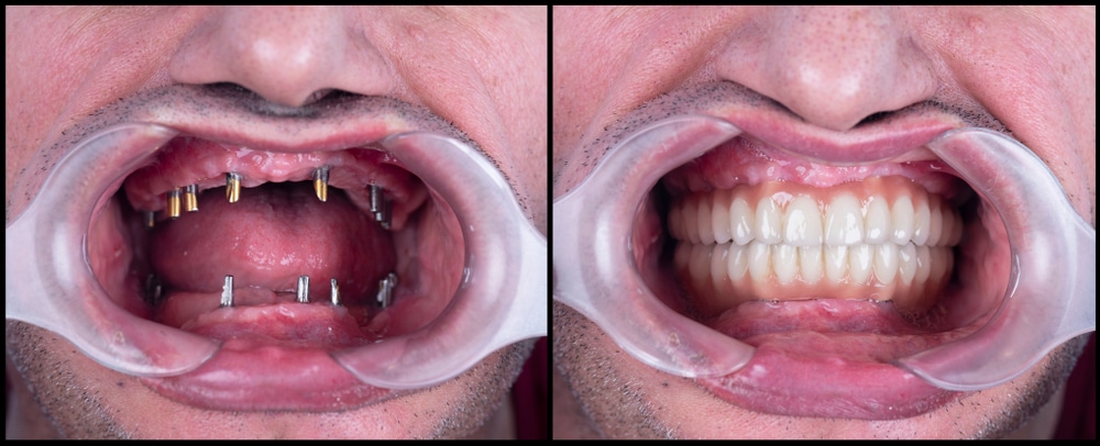 Tratamiento de implantes en Los Angeles | Implante dental en Beverly Hills