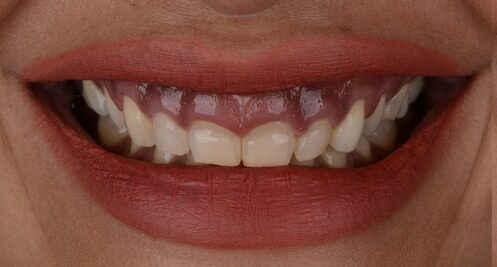 What is a Hyper Mobile Lip? | The Total Smile | Beverly Hills